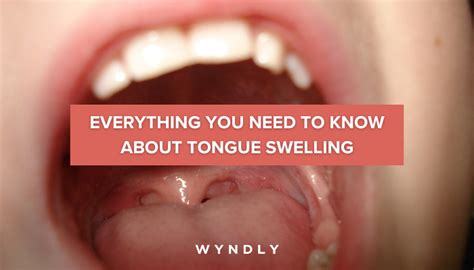 Swollen Tongue Causes Symptoms And Treatment 2025 And Wyndly