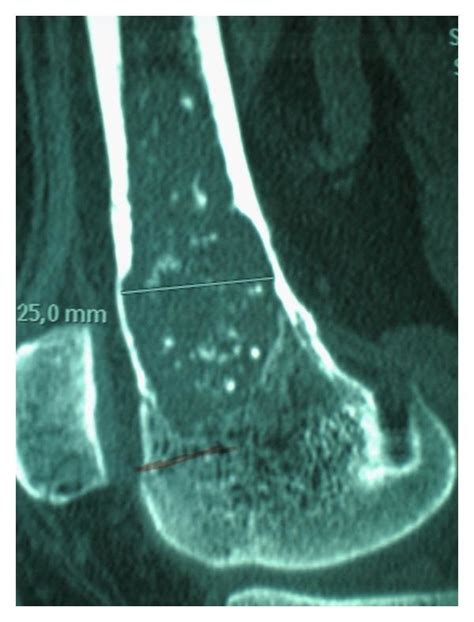 Ct Scan Image Showing Endosteal Scalloping Of A Distal Femur Cartilage