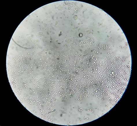 Premium Photo Budding Yeast Cells In Patient Urine Uti Pyelonephritis