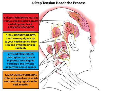 Trigger Point Therapy Tension Type Headaches Tth Niel Asher Healthcare