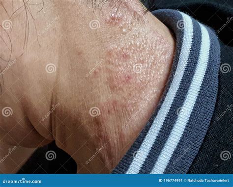 Skin Allergy Pictures There Is A Red Itchy Rash On The Neck Of Asian Women Stock Image Image
