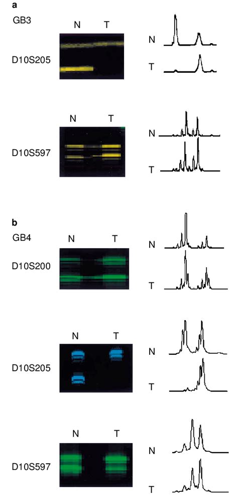 Detection Of Loh In Malignant Astrocytomas By A ¯uorescence Based