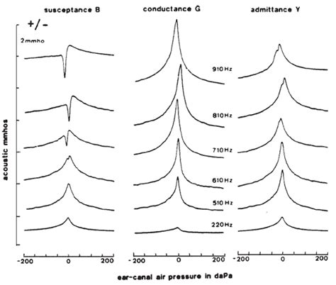 Tympanometry High Compliance At Samantha Sternberg Blog