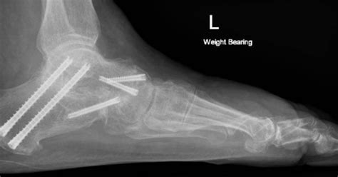 Midfoot And Hindfoot Fusion Surgery Dr Graff Adelaide