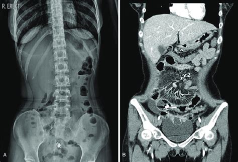 Abdominal Radiograph And Computed Tomography Scan 11 Months After