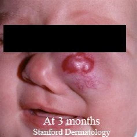 Vascular Malformations Clinic Hemangiomas Dermatology Stanford Medicine