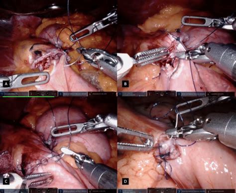 A First Layer Of Closure In An Inverted T Extramucosal Continuous