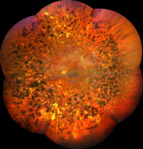 Proliferative Diabetic Retinopathy Andrea Cusumano