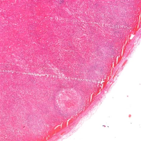 An Infarcted Lymph Node Just Adjacent To Cecum Download Scientific