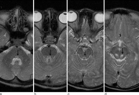 Medial Longitudinal Fasciculus Pathway