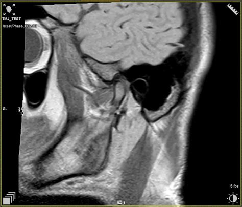 Video Samar Hamid On Linkedin Dynamic Mri Of Tmj Disc Throughout Jaw