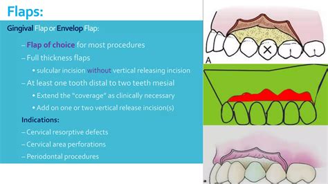 Oral Surgery Flaps Desgning Pdf