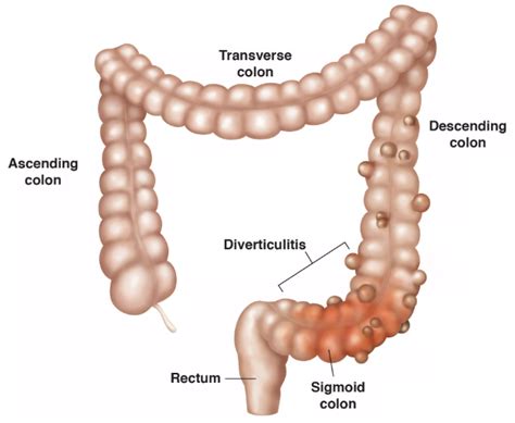 What Does Diverticulitis Look Like In The Colon