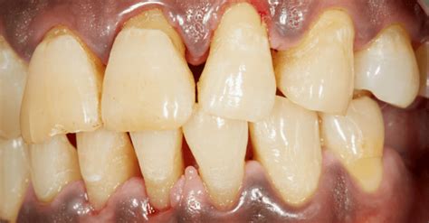 Periodontitis Bone Graft Procedure Restoring Dental Bone Loss Share