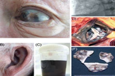 Homogentisic Acid Oxidase Deficiency