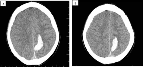 A And B Non Contrast Brain Ct Showing Hyperacute Hematoma In The Left Download Scientific