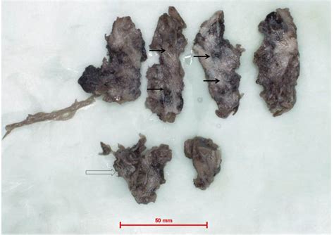 Cut Slices Of The Exophytic Component Of The Tumour Thin Arrows Show Download Scientific