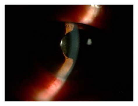 Preoperative Slit Lamp Photograph Of The Right Eye In Case 1 A Shallow