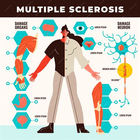 Premium Vector Hand Drawn Flat Design Multiple Sclerosis Infographic