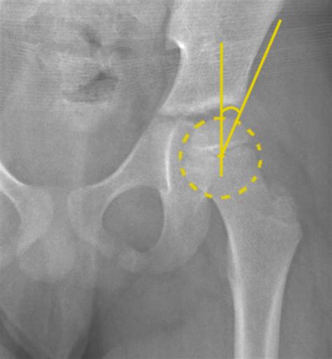 6 Years Old Infant Successfully Treated For Ddh In The Past