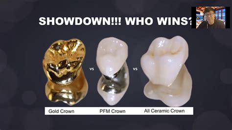 What Is Metal Ceramic Crown At Kaitlyn Maund Blog