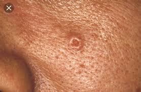 Sebaceous Hyperplasia