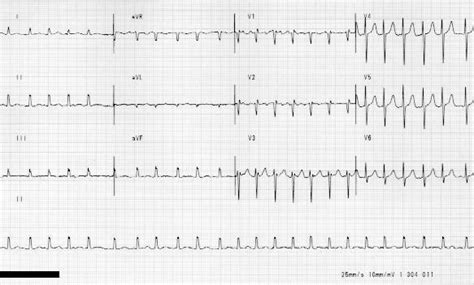 Pensigoblog Tombstones On Ekg