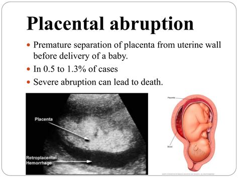 Placenta Abruption Pptx