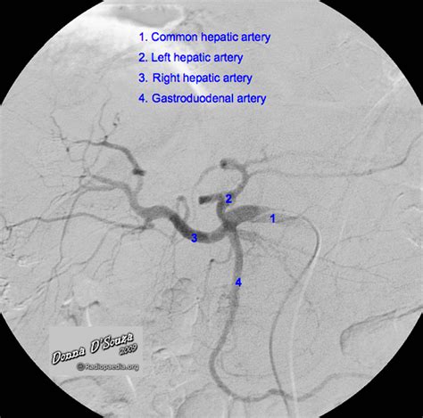 Hepatic Artery