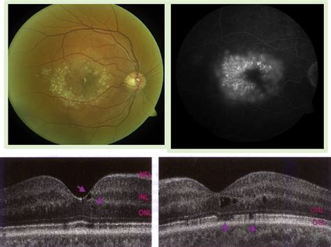 Crystalline Retinopathy Unifying Pathogenic Pathways Of Disease