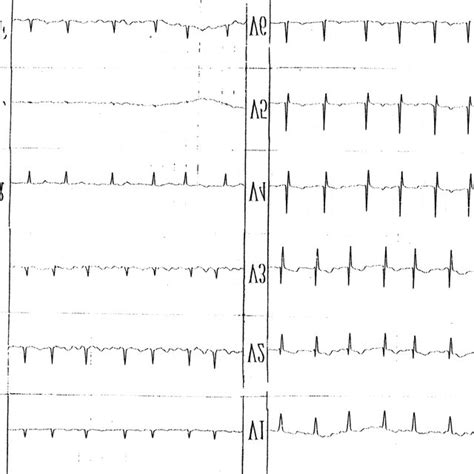 Pdf A Case Of Variant Angina Associated With Hyperthyroidism