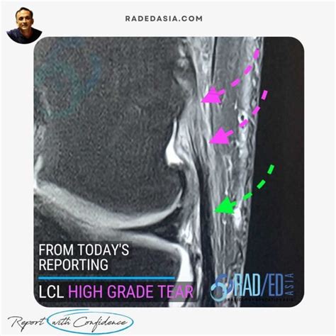 Knee Lateral Collateral Ligament Lcl Tear Radiology Education Asia