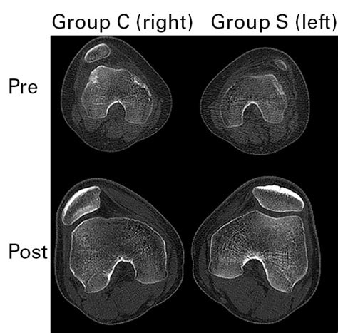 Trochlear Notch Femur
