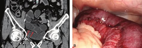 A Contrast Ct Images In Case 1 A Closed Loop Obstruction Was