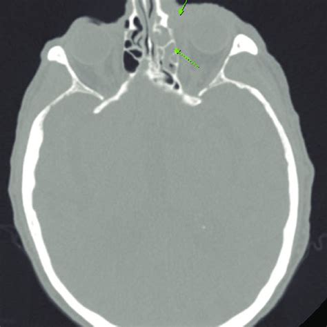 Ct Of Orbits With Contrast Showing Opacification Of Left Frontal Sinus