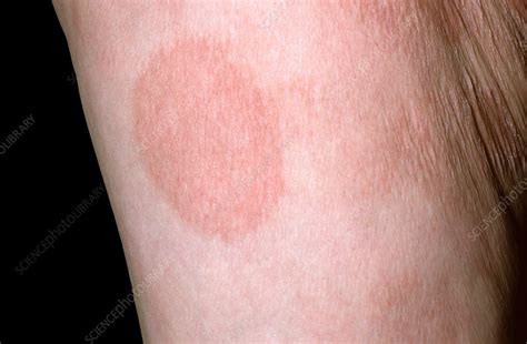 Plaque Parapsoriasis Stock Image C0348063 Science Photo Library