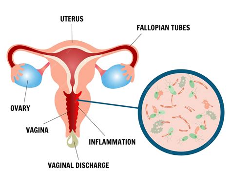 Secreción Vaginal Del Sistema Reproductivo Femenino O Infográfico En