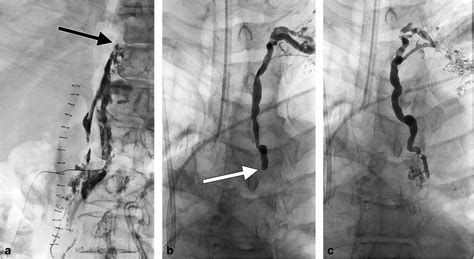 Thoracic Duct Embolization Using Transabdominal Antegrade And
