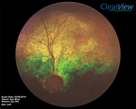 Examples Of A Normal Fundus And Six Clinical Signs Of Chorioretinal