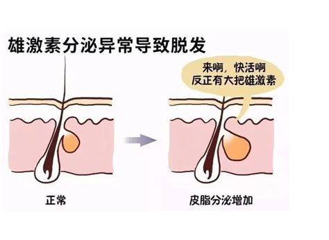 为什么脱发的是我——雄激素性脱发