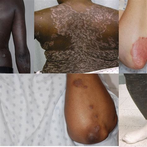Psoriatic Lesions On Multiple Skin Tones On The Fitzpatrick Vi Skin Download Scientific