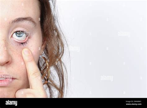 Half Face Of Woman With Finger Lowering The Eyelid For An Eye Examination Possible Symptom Of
