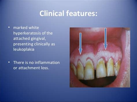 Syndromes Affecting The Periodontium Khushbu13 4 08