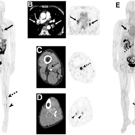 Petct Imaging Of Dvt And Pulmonary Embolism Pe Using Activated