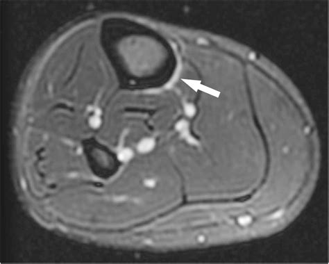 A 15 Year Old Female Track Athlete With Fredericson Grade 1 Injury