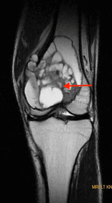 Mri Of Left Knee Showing Well Defined Multiloculated Expansile Altered