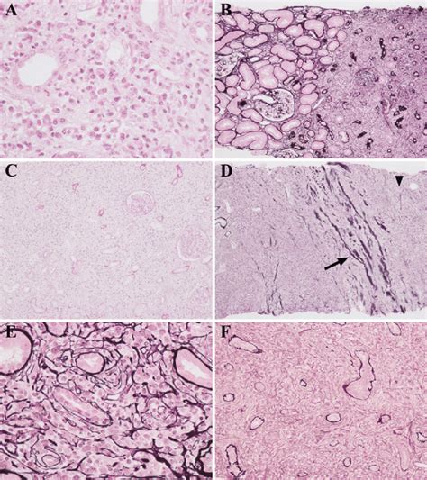 Light Microscopy Findings Of The Renal Interstitium Before