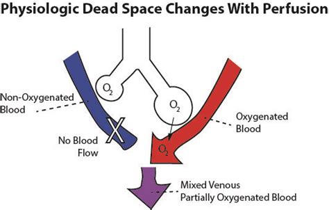 Ventilation Perfusion Mismatch Artofit