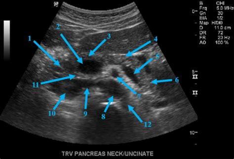 Pancreas Anatomy Ultrasound