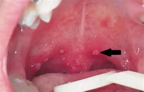宝宝上颚有白泡图片上颚图片第9页大山谷图库
